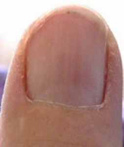 Redness under Fingernails