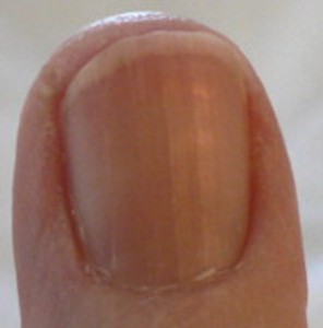 Redness under Fingernails
