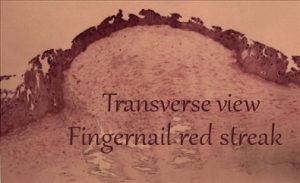 Redness under Fingernails