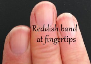 Reddish band at fingertips