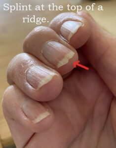 Unbending COPD Fingernails 2