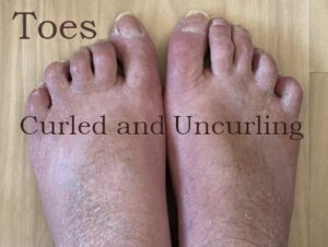 Do you have curled toes?